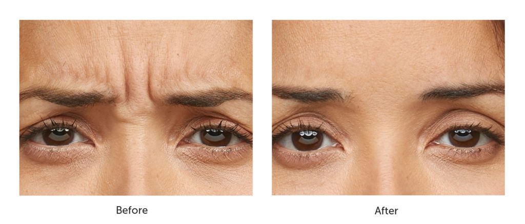 Neuromodulators (Botox®, Nuceiva) - Botox Bedford & Sydney - First ...