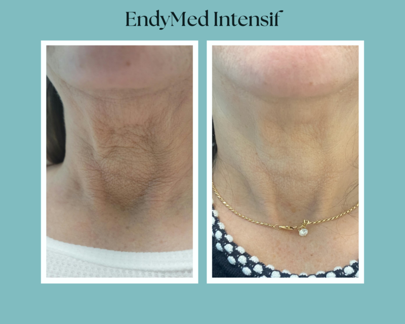 EndyMed - First Impressions