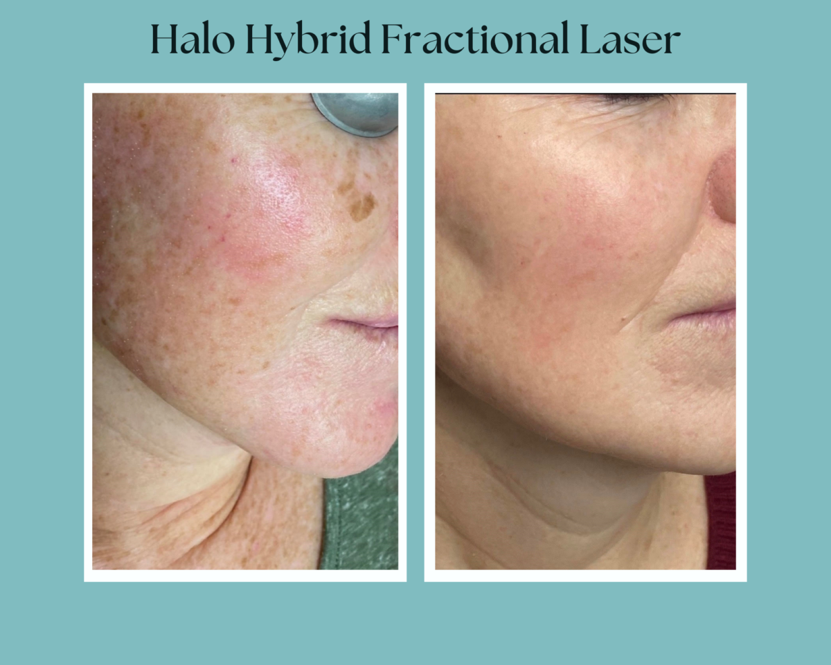 Halo Hybrid Fractional Laser - First Impressions